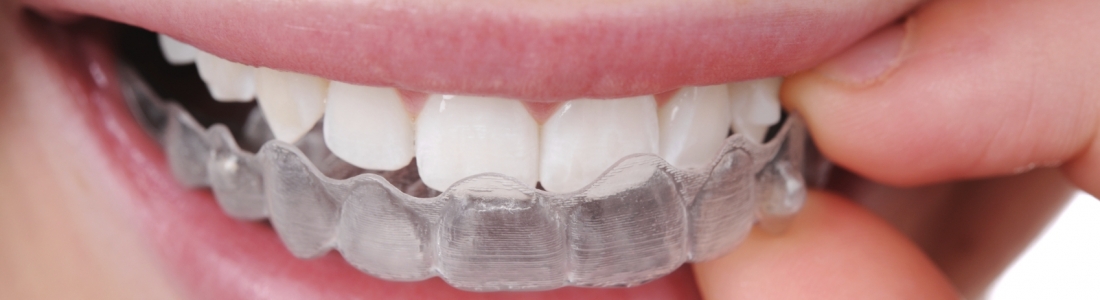 invisible-braces - Strand on the Green Dental